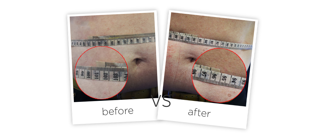 Laser Shape Body Slimming System - ADSS Laser